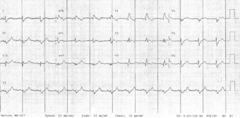 Right Bundle Branch Block (RBBB) • LITFL • ECG Library Diagnosis