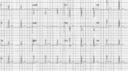 OMI: Replacing the STEMI misnomer • LITFL • ECG Library
