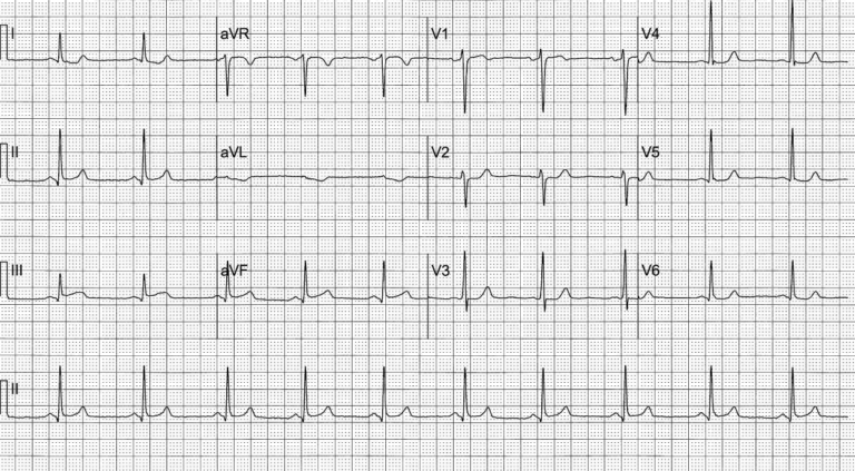OMI: Replacing the STEMI misnomer • LITFL • ECG Library