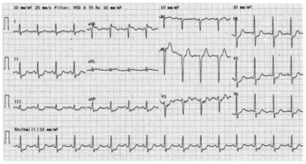 OMI: Replacing the STEMI misnomer • LITFL • ECG Library