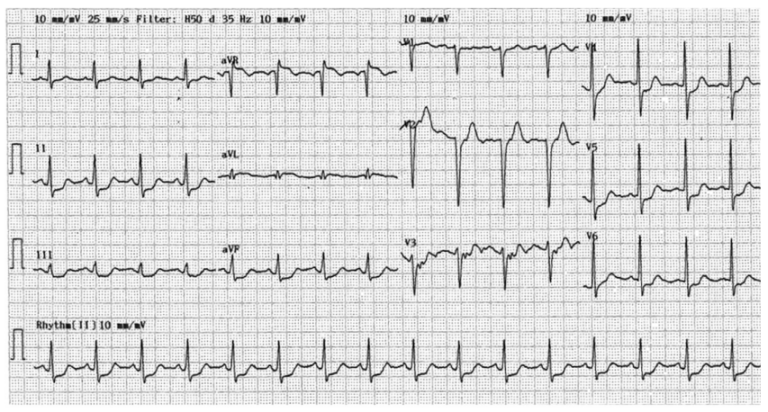 OMI: Replacing the STEMI misnomer • LITFL • ECG Library