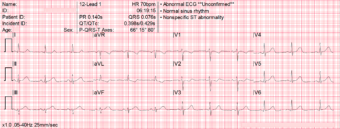 OMI: Replacing the STEMI misnomer • LITFL • ECG Library