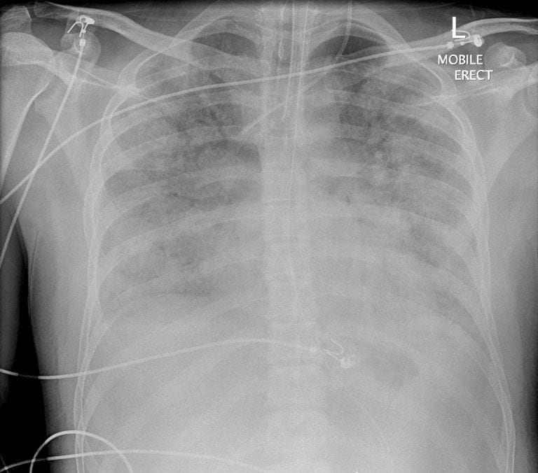Cxr Case 011 • Litfl • Chest X Ray Self Assessment Quiz