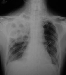 CXR Case 042 • LITFL • Chest X-ray Self-Assessment Quiz