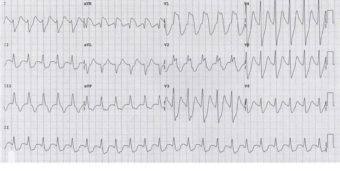 Seizures, Somnolence and a Scary ECG • LITFL • ECG Exigency