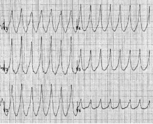 VT versus SVT • LITFL Medical Blog • ECG Library Basics