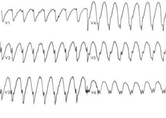 VT versus SVT • LITFL Medical Blog • ECG Library Basics