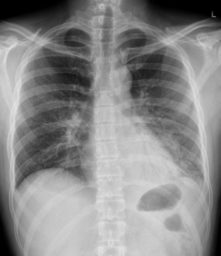 CXR Case 060 • LITFL • Chest X-ray Self-Assessment Quiz
