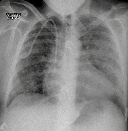 CXR Case 081 • LITFL • Chest X-ray Self-Assessment Quiz