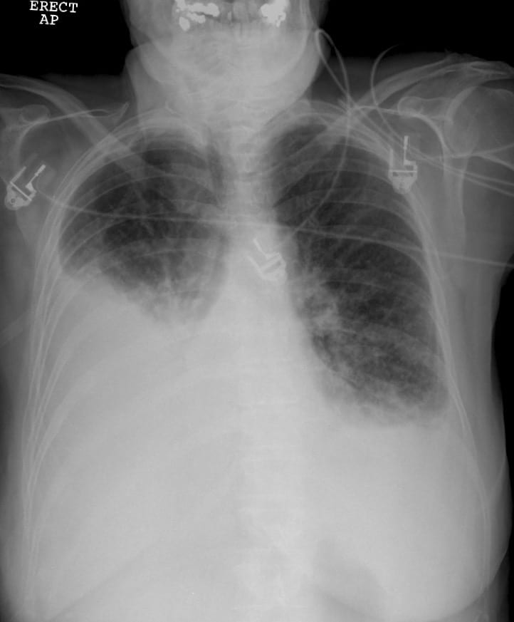 CXR Case 083 • LITFL • Chest X-ray Self-Assessment Quiz