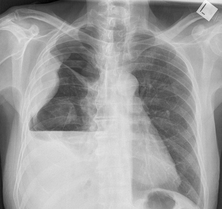 CXR Case 095 • LITFL • Chest X-ray Self-Assessment Quiz