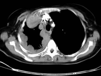 CXR Case 097 • LITFL • Chest X-ray Self-Assessment Quiz