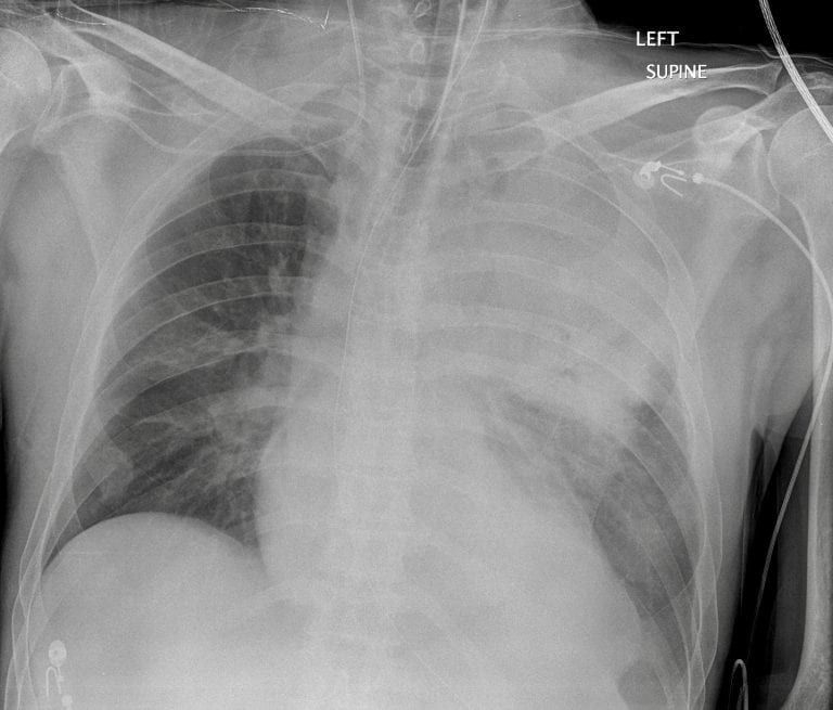 CXR Case 098 • LITFL • Chest X-ray Self-Assessment Quiz