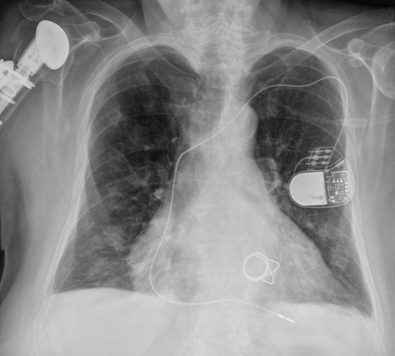 CXR Case 109 • LITFL • Chest X-ray Self-Assessment Quiz