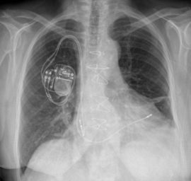 CXR Case 112 • LITFL • Chest X-ray Self-Assessment Quiz