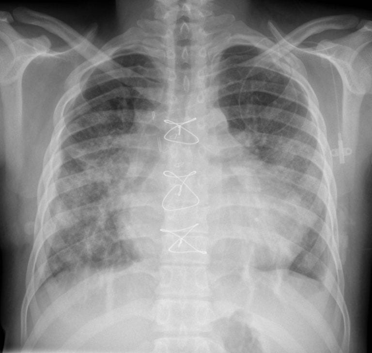 CXR Case 113 • LITFL • Chest X-ray Self-Assessment Quiz