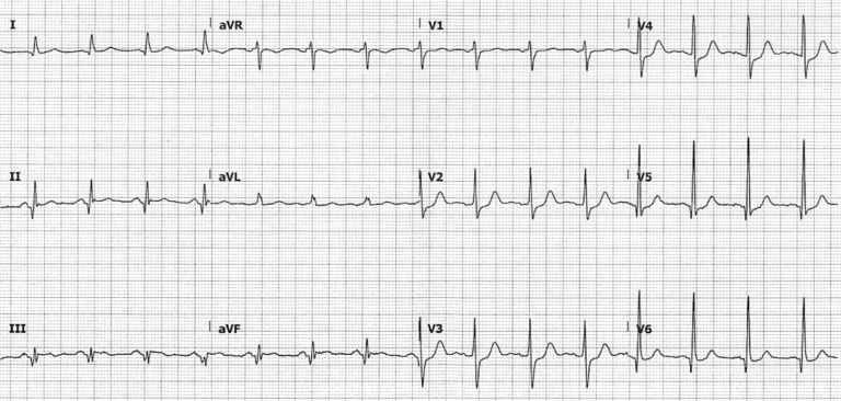 ST depression does not localise • LITFL • ECG Library