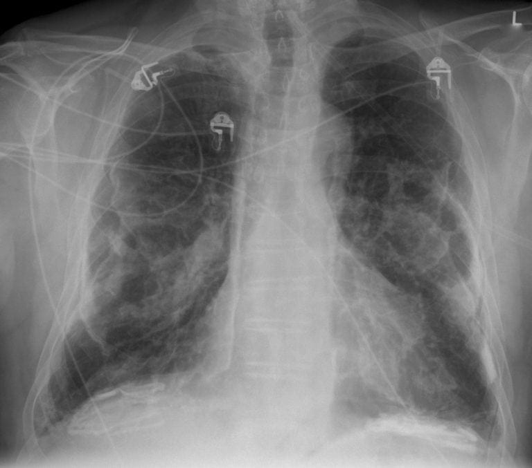 CXR Case 128 • LITFL • Chest X-ray Self-Assessment Quiz