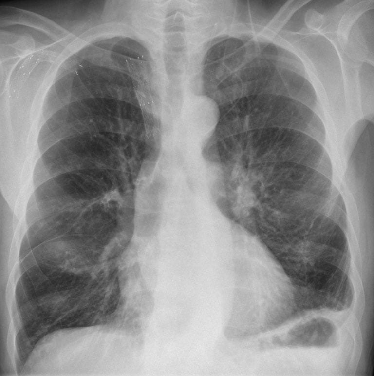 CXR Case 134 • LITFL • Chest X-ray Self-Assessment Quiz