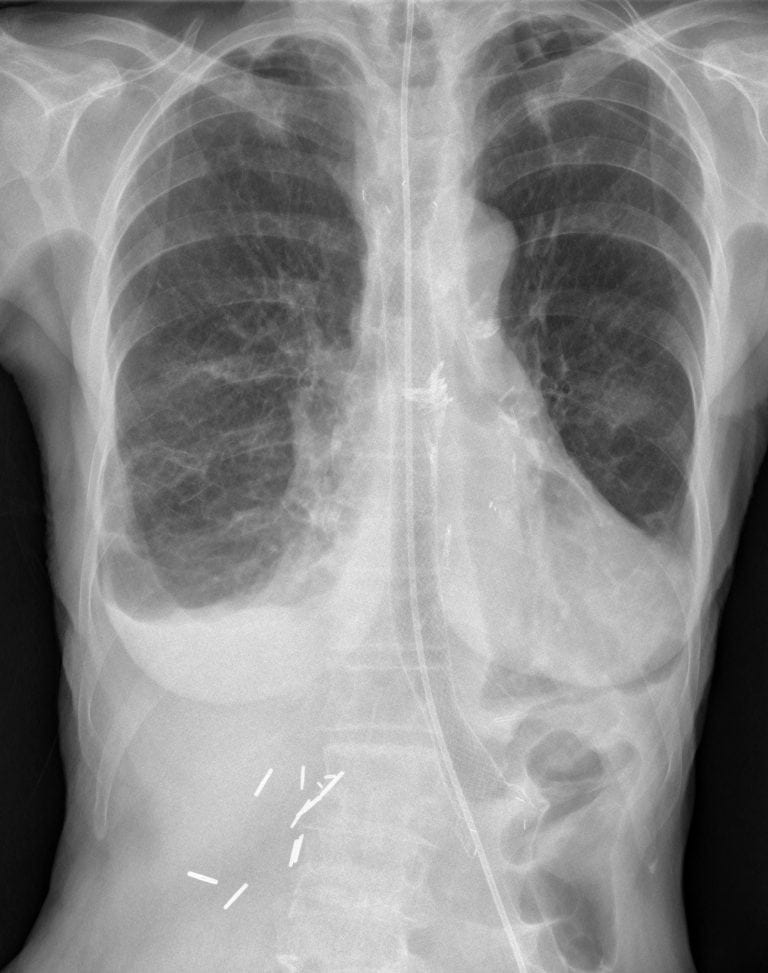 CXR Case 144 • LITFL • Chest X-ray Self-Assessment Quiz
