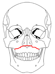 Le Fort facial fractures • LITFL Medical Blog • Medical Eponym Library