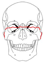 Le Fort facial fractures • LITFL Medical Blog • Medical Eponym Library