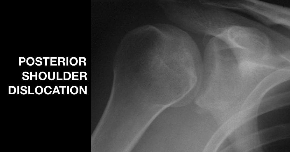 Posterior Shoulder Dislocation LITFL Trauma Library Posterior Shoulder Dislocation LITFL Trauma Library