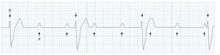 AV block: 3rd degree (complete heart block) • LITFL • ECG Library