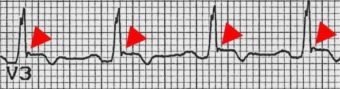 Epsilon Wave • LITFL Medical Blog • ECG Library Basics