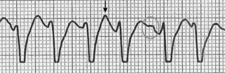 VT versus SVT • LITFL Medical Blog • ECG Library Basics