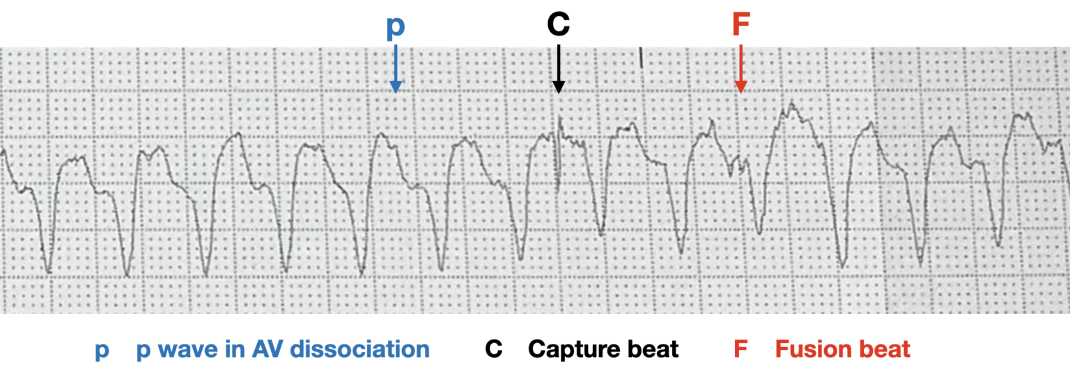 VT versus SVT • LITFL Medical Blog • ECG Library Basics