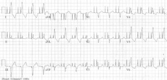 Pacemaker Rhythms – Normal Patterns • LITFL • ECG Library Diagnosis