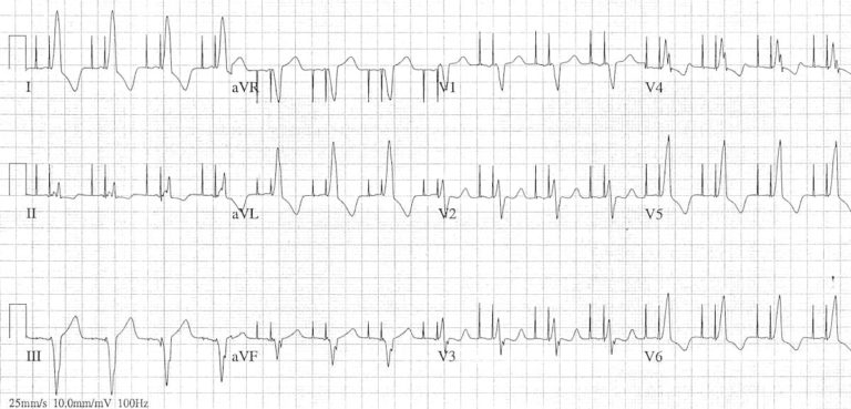 Pacemaker Rhythms – Normal Patterns • LITFL • ECG Library Diagnosis