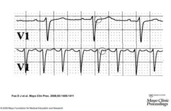 Supraventricular Tachycardia (SVT) • LITFL • ECG Library Diagnosis