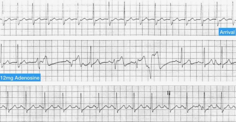 Supraventricular Tachycardia (SVT) • LITFL • ECG Library Diagnosis