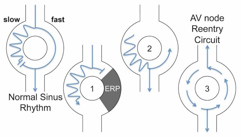 Supraventricular Tachycardia (SVT) • LITFL • ECG Library Diagnosis