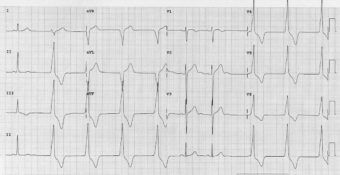 Accelerated Idioventricular Rhythm (AIVR) • LITFL • ECG Library
