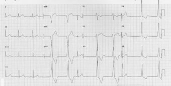 Accelerated Idioventricular Rhythm (AIVR) • LITFL • ECG Library
