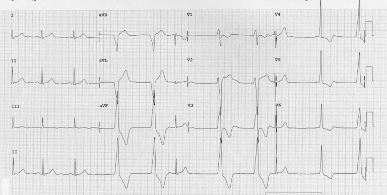 Accelerated Idioventricular Rhythm (AIVR) • LITFL • ECG Library
