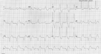 Accelerated Idioventricular Rhythm (AIVR) • LITFL • ECG Library