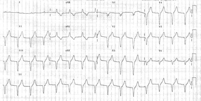 Accelerated Idioventricular Rhythm (AIVR) • LITFL • ECG Library
