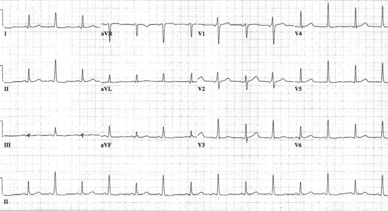 ECG Findings in Massive Pericardial Effusion • LITFL • ECG Library