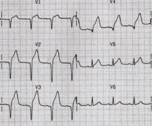 Q Wave • LITFL • ECG Library Basics