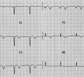 Q Wave • LITFL • ECG Library Basics