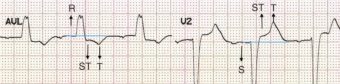 Premature Ventricular Complex (PVC) • LITFL • ECG Library Diagnosis
