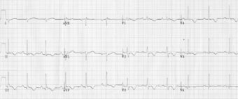 Epsilon Wave • LITFL Medical Blog • ECG Library Basics