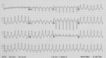 Epsilon Wave • LITFL Medical Blog • ECG Library Basics