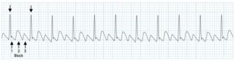 Atrial Flutter • LITFL • ECG Library Diagnosis