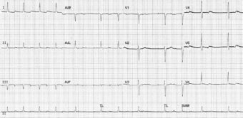 Pacemaker Rhythms – Normal Patterns • LITFL • ECG Library Diagnosis