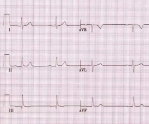 ECG Axis Interpretation • LITFL • ECG Library Basics